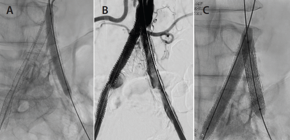 PAD and the SABER™ .035 PTA Catheter - Endovascular Today