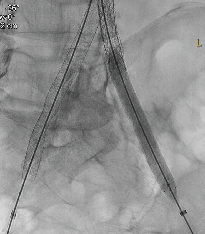PAD and the SABER™ .035 PTA Catheter - Endovascular Today