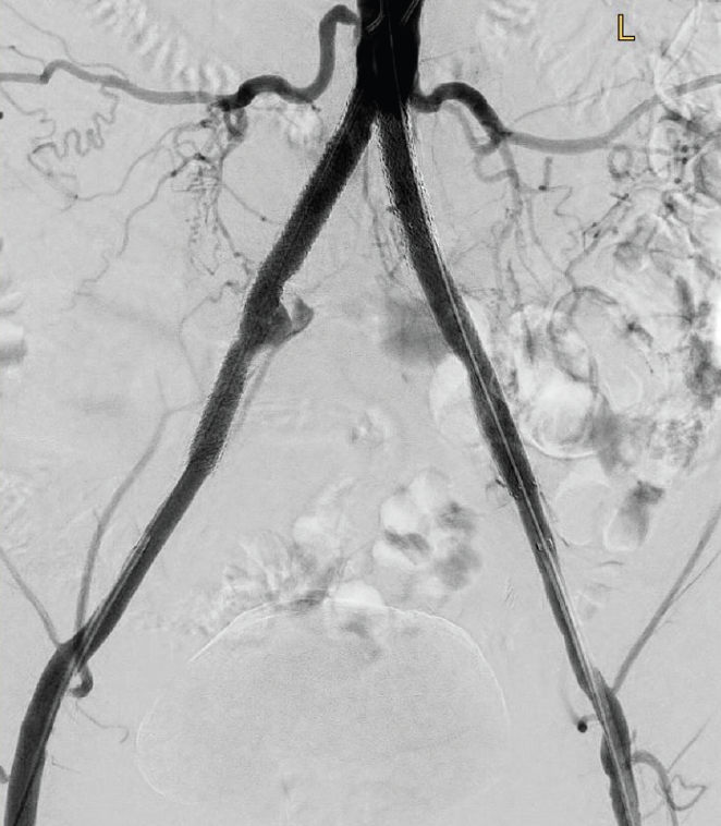 PAD and the SABER™ .035 PTA Catheter - Endovascular Today