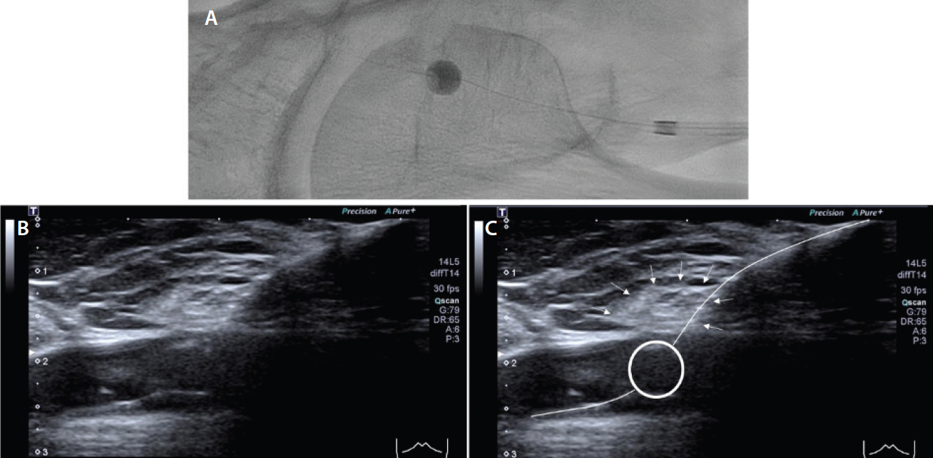 PAD and the SABER™ .035 PTA Catheter - Endovascular Today