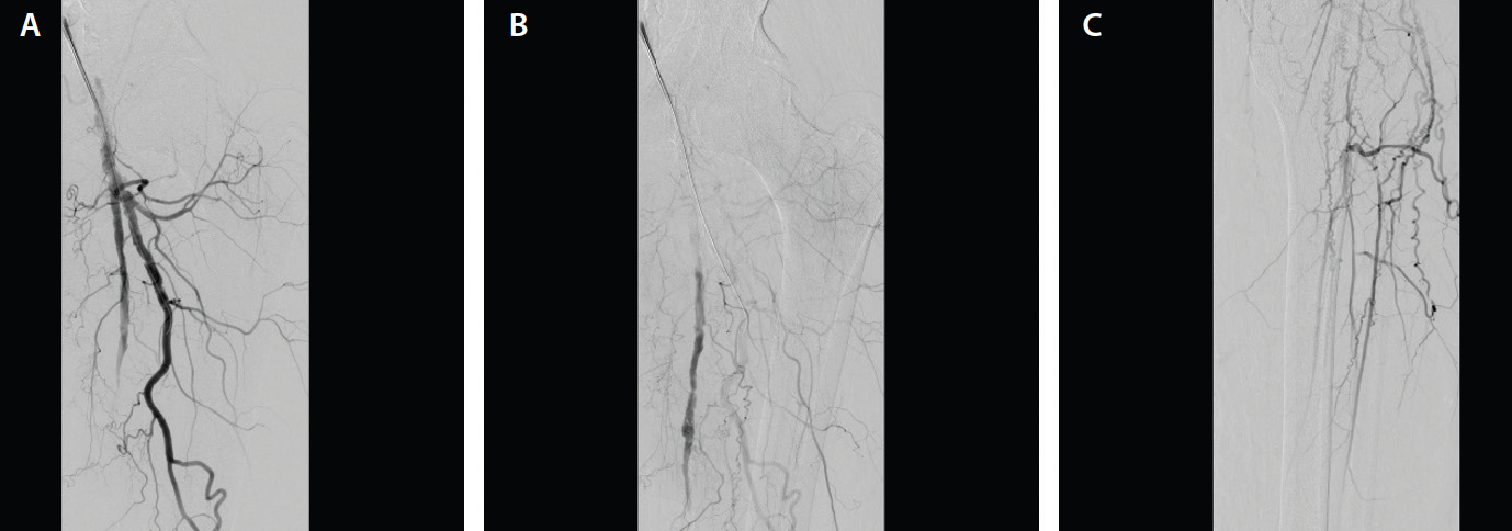 PAD and the SABER™ .035 PTA Catheter - Endovascular Today