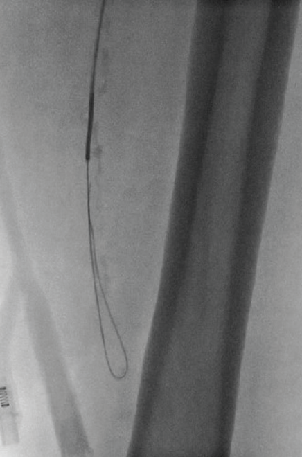 PAD and the SABER™ .035 PTA Catheter - Endovascular Today