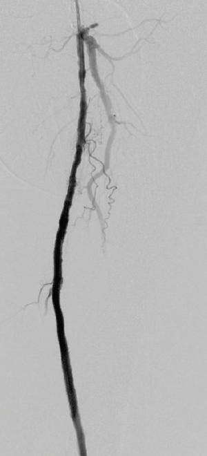 PAD and the SABER™ .035 PTA Catheter - Endovascular Today