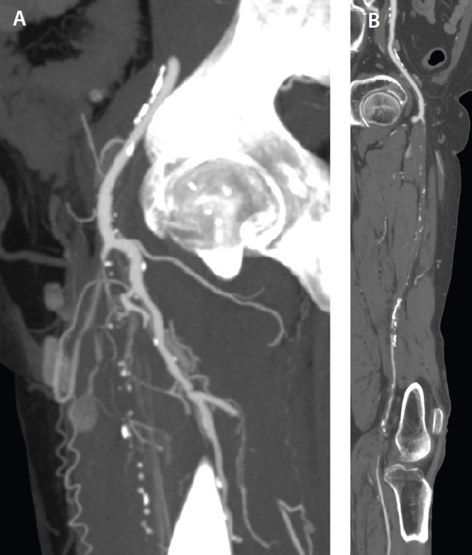 PAD and the SABER™ .035 PTA Catheter - Endovascular Today