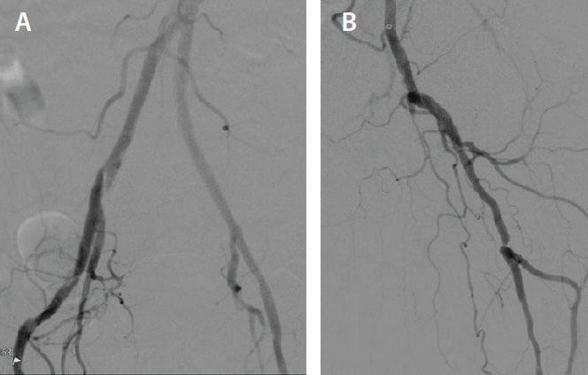 PAD and the SABER™ .035 PTA Catheter - Endovascular Today