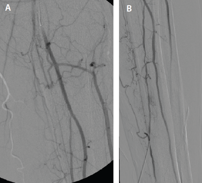 PAD and the SABER™ .035 PTA Catheter - Endovascular Today
