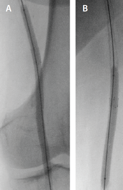 PAD and the SABER™ .035 PTA Catheter - Endovascular Today