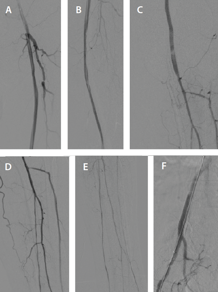 PAD and the SABER™ .035 PTA Catheter - Endovascular Today
