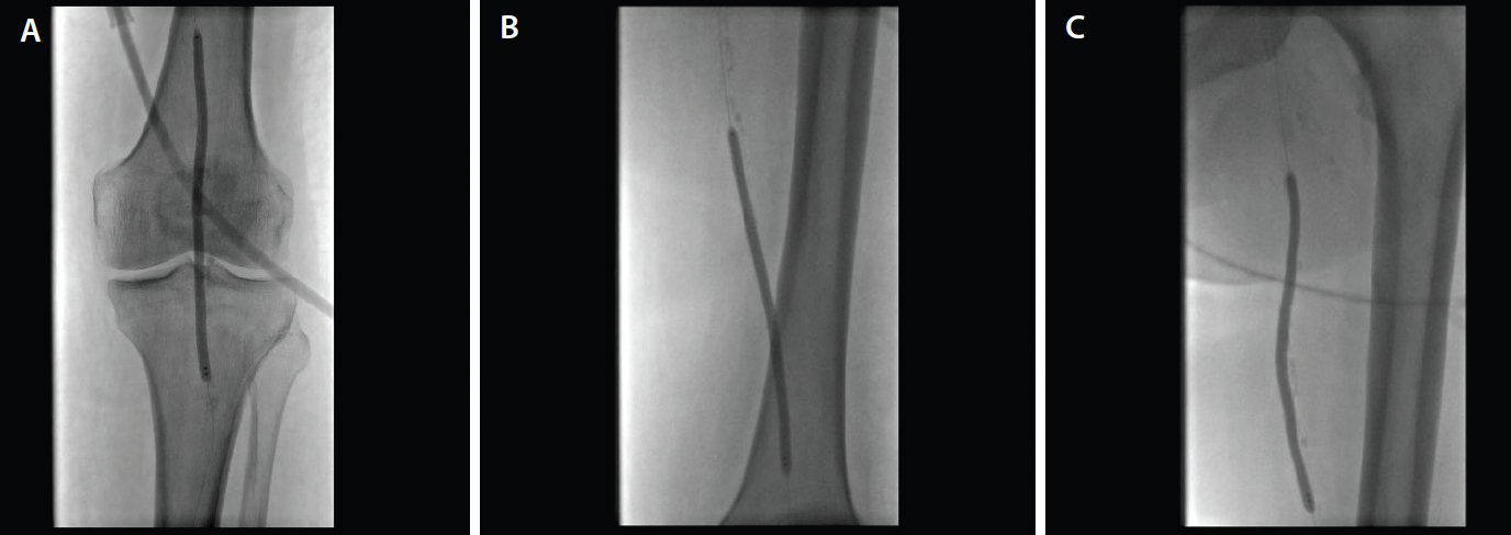 PAD and the SABER™ .035 PTA Catheter - Endovascular Today