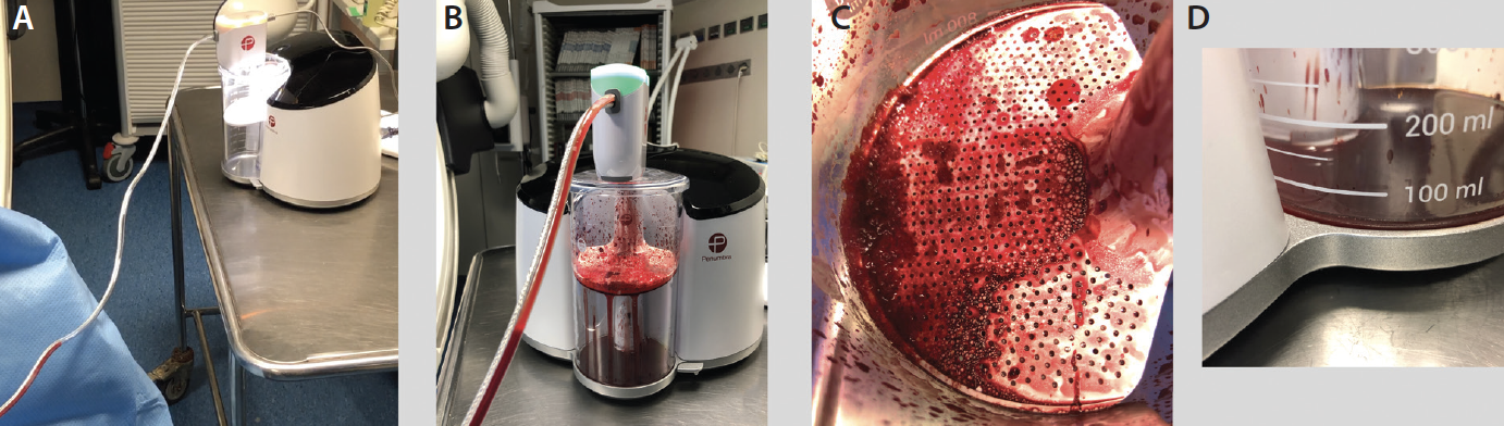 Real-World Perspectives on Thrombus Removal With the Lightning ...
