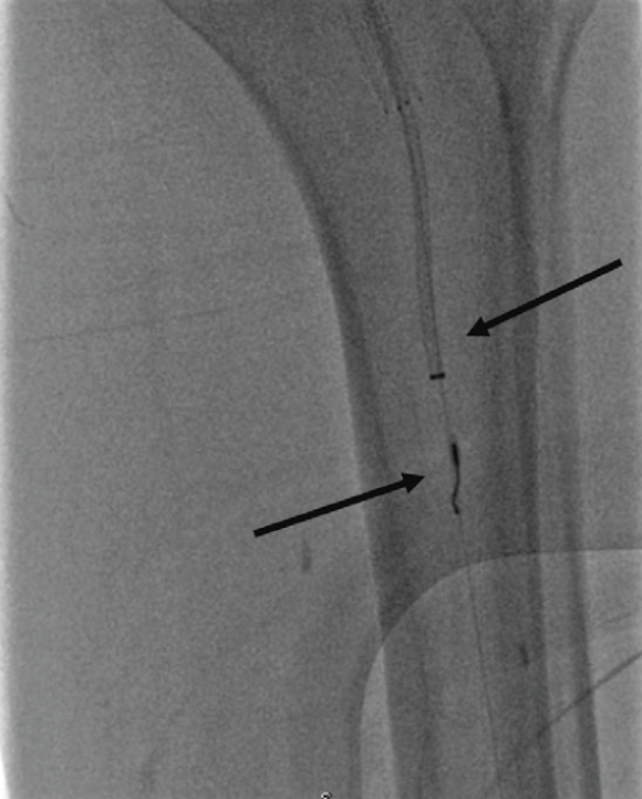 Real-World Perspectives on Thrombus Removal With the Lightning ...