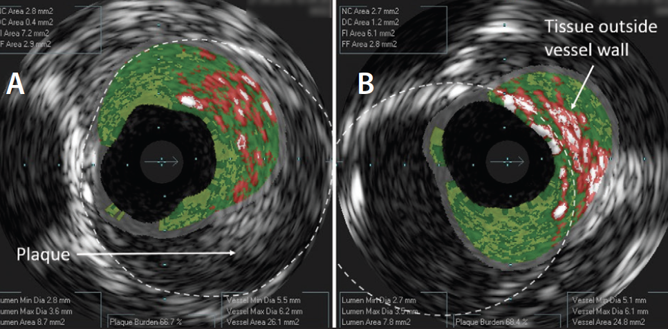 Optimizing Technique for Success: A Guide for the Use of IVUS in ...