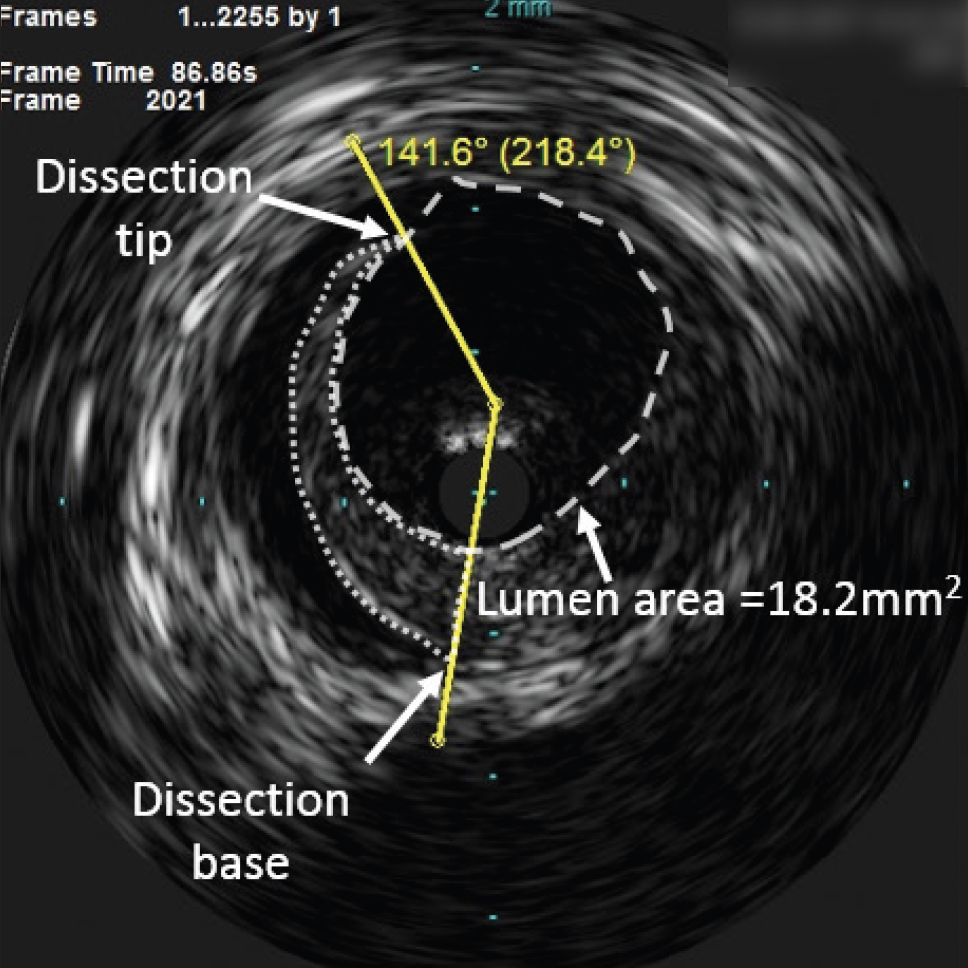 Optimizing Technique for Success: A Guide for the Use of IVUS in ...