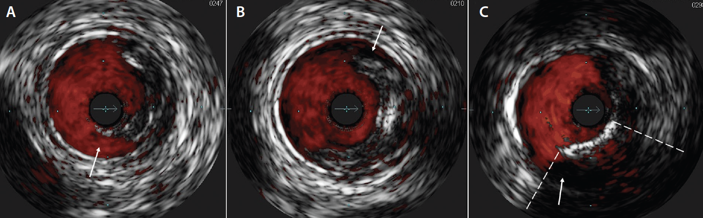 Optimizing Technique for Success: A Guide for the Use of IVUS in ...