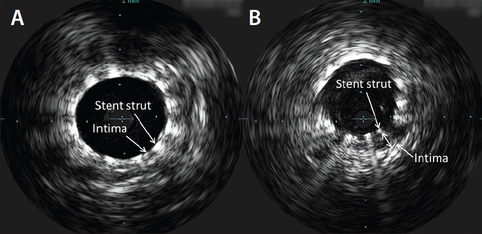 Optimizing Technique for Success: A Guide for the Use of IVUS in ...