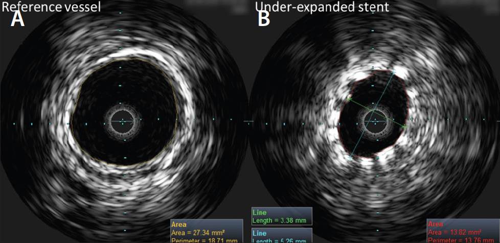 Optimizing Technique for Success: A Guide for the Use of IVUS in ...