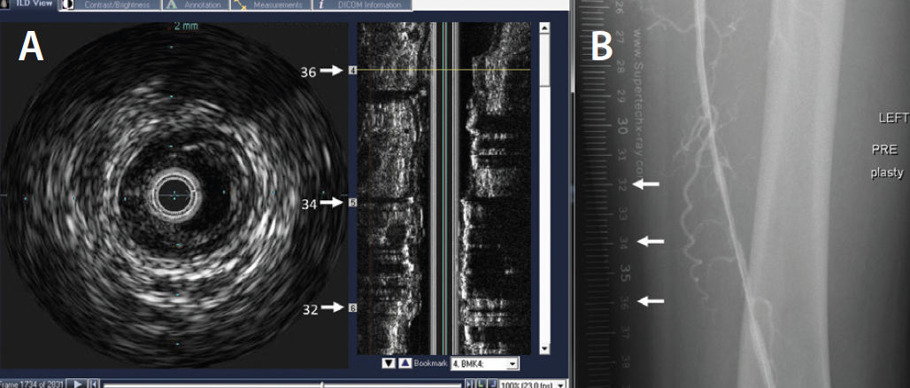 Optimizing Technique for Success: A Guide for the Use of IVUS in ...