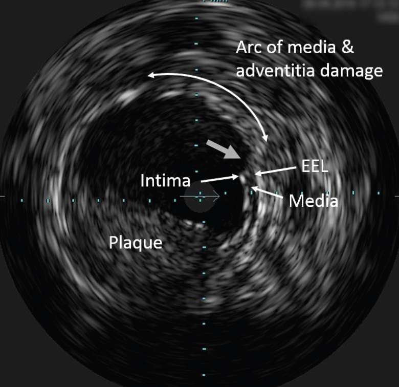 Optimizing Technique for Success: A Guide for the Use of IVUS in ...