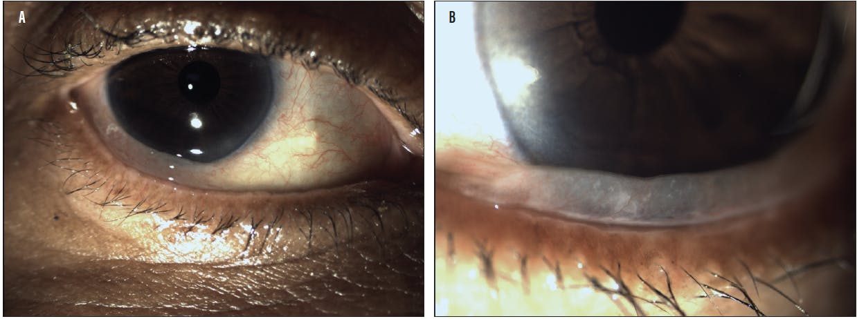 Uveitis Vs Conjunctivitis Viral Conjunctivitis Hi Res Stock
