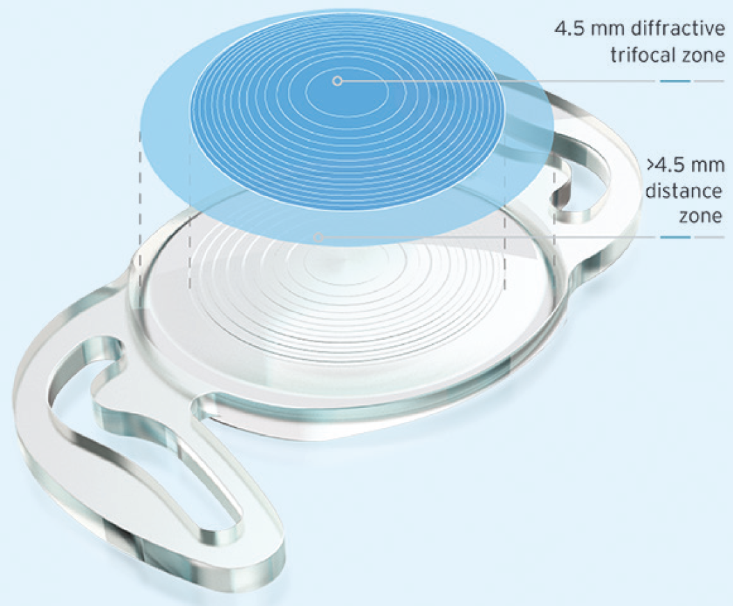 Where Are We Going With IOL Technology? - Modern Optometry