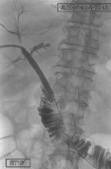 State of the Art in Interventional Oncology: Case Discussions ...
