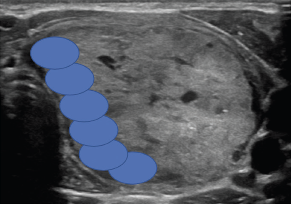 New Horizons in Ablation: Breast and Thyroid - Endovascular Today
