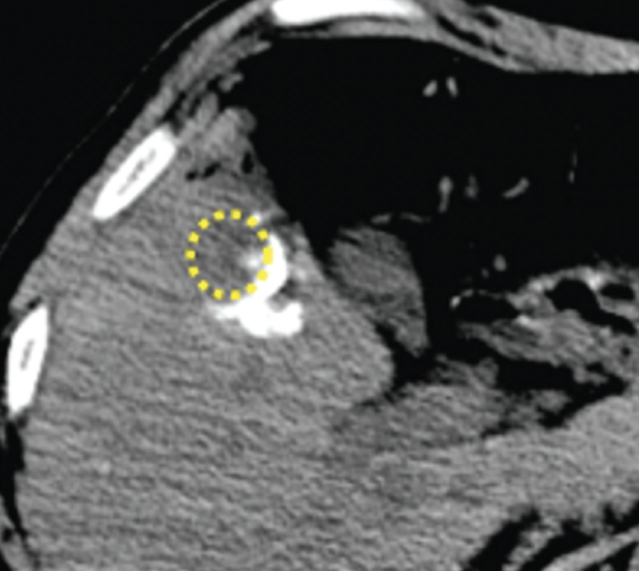 Intratumoral Therapies: How to Prepare Your Team for the Coming Wave ...