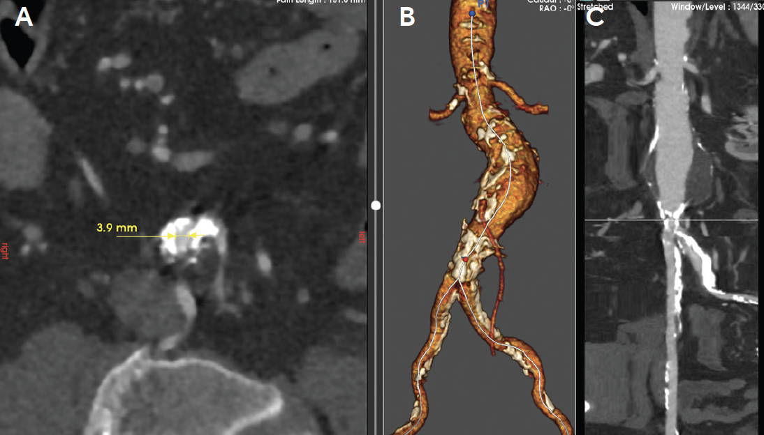 The Role of Adaptive Sealing Technology in Clinical Practice ...
