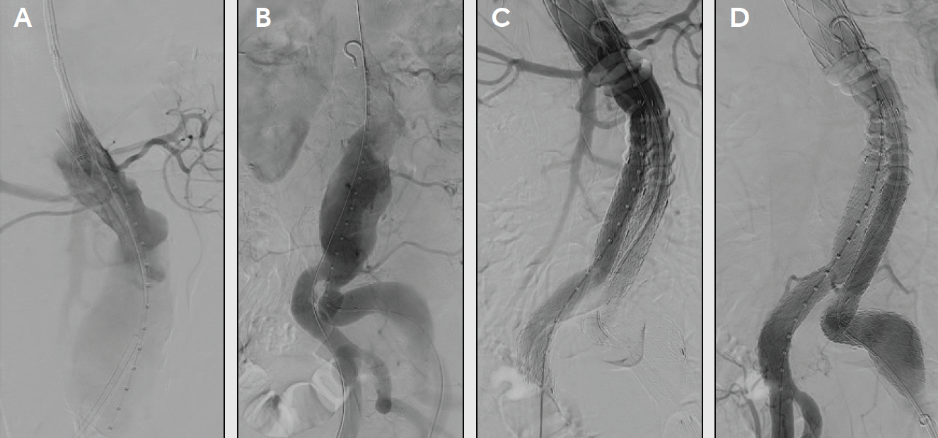 The Role of Adaptive Sealing Technology in Clinical Practice ...