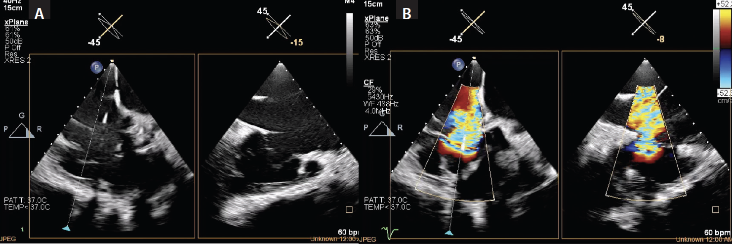Three-Dimensional Intracardiac Echocardiography Use in Tricuspid Valve ...