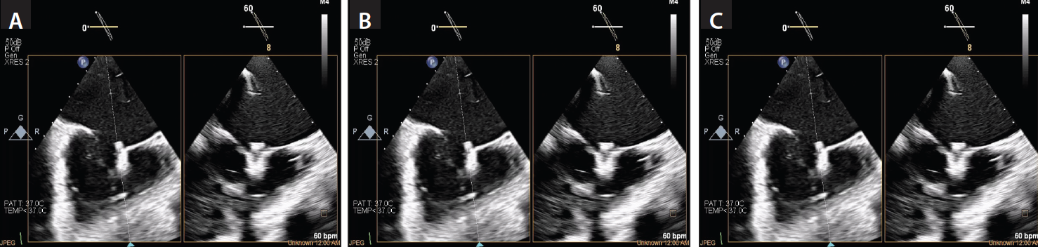 Three-Dimensional Intracardiac Echocardiography Use in Tricuspid Valve ...