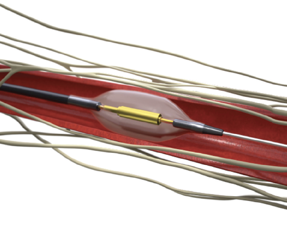 How to Denervate With Current Renal Denervation Device Iterations ...