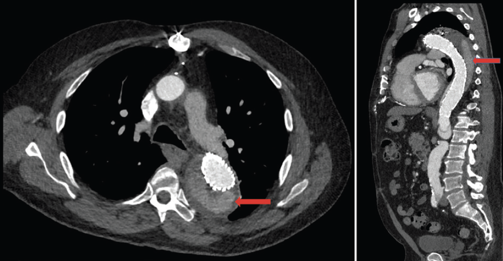 Embolization Techniques for False Lumen Treatment - Endovascular Today