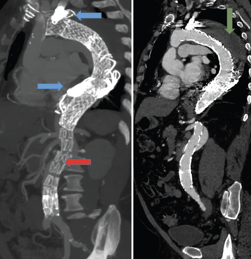 Embolization Techniques for False Lumen Treatment - Endovascular Today