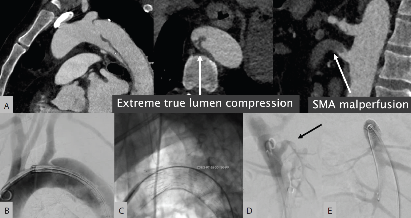 Managing Ruptured Acute and Chronic Aortic Dissections - Endovascular Today