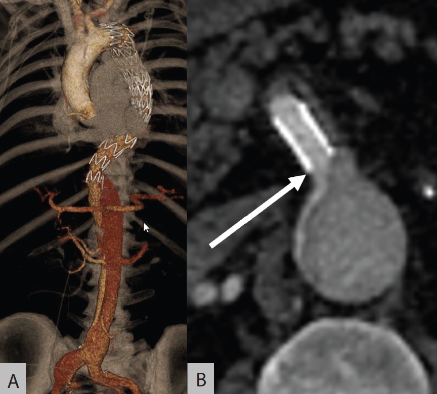 Managing Ruptured Acute and Chronic Aortic Dissections - Endovascular Today