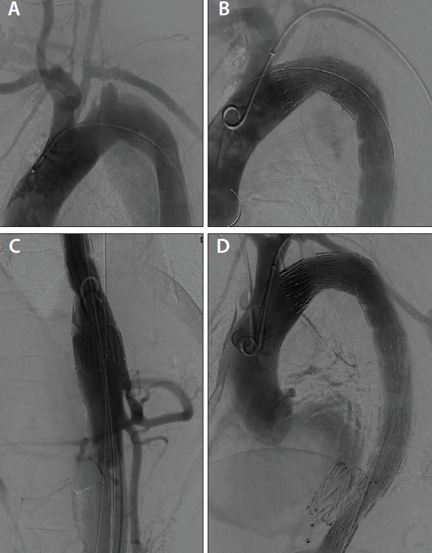 The Importance of “Backdoor” Treatment to Close Distal Entry Tears in ...