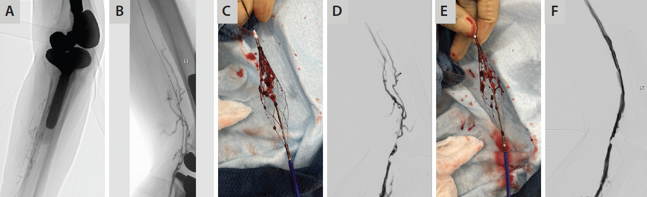 First Reports on the Novel InThrill Thrombectomy System - Endovascular Today