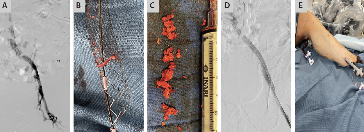 First Reports on the Novel InThrill Thrombectomy System - Endovascular ...