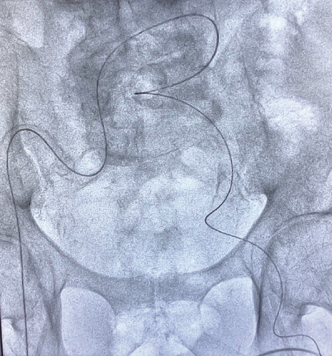 Radial-to-Peripheral Has Arrived—What Does the Future Hold ...