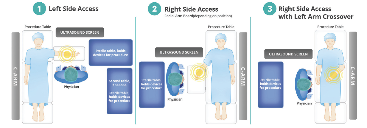 Integrating Radial-to-Peripheral Into Your Practice - Endovascular Today