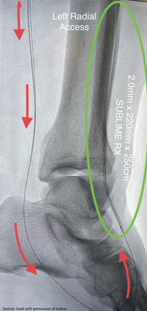 Integrating Radial-to-Peripheral Into Your Practice - Endovascular Today