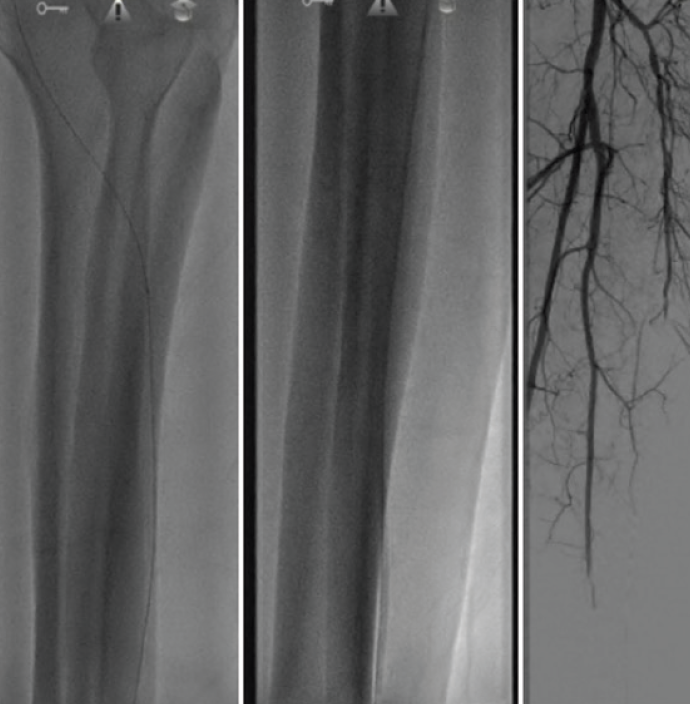 Radial-to-Peripheral Has Arrived—What Does the Future Hold ...