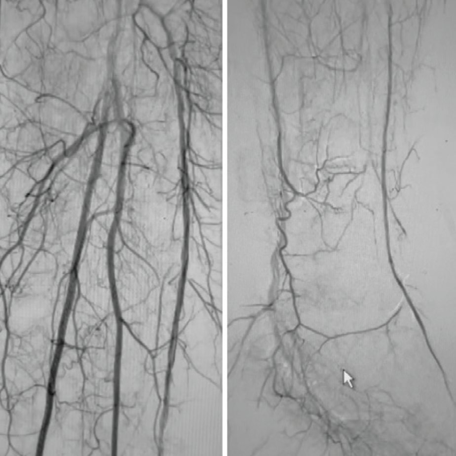 Radial-to-Peripheral Has Arrived—What Does the Future Hold ...