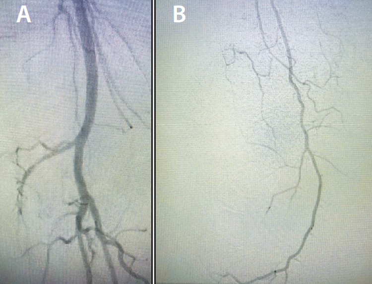 Integrating Radial-to-Peripheral Into Your Practice - Endovascular Today
