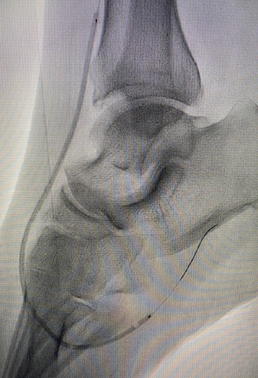 Integrating Radial-to-Peripheral Into Your Practice - Endovascular Today