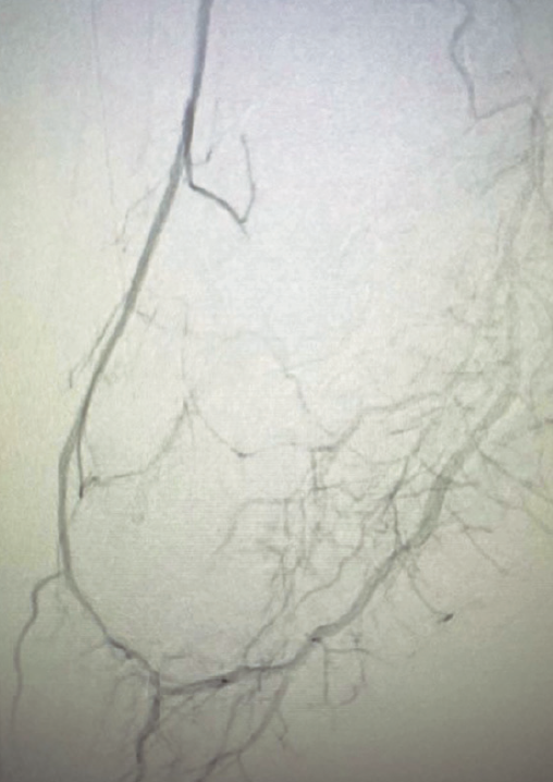 Integrating Radial-to-Peripheral Into Your Practice - Endovascular Today