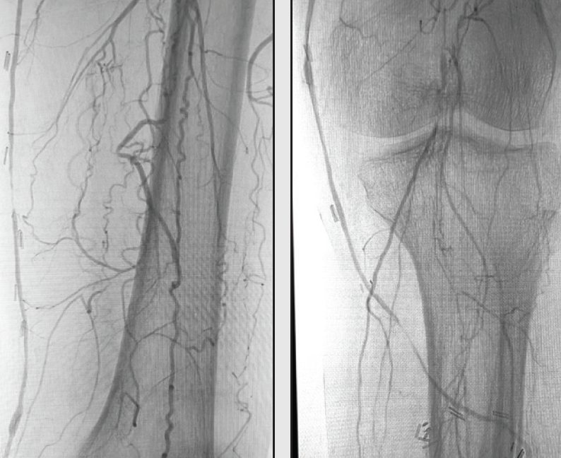 Practice Profile: Radial-to-Pedal Access: A “Mic-Drop” Innovation That ...