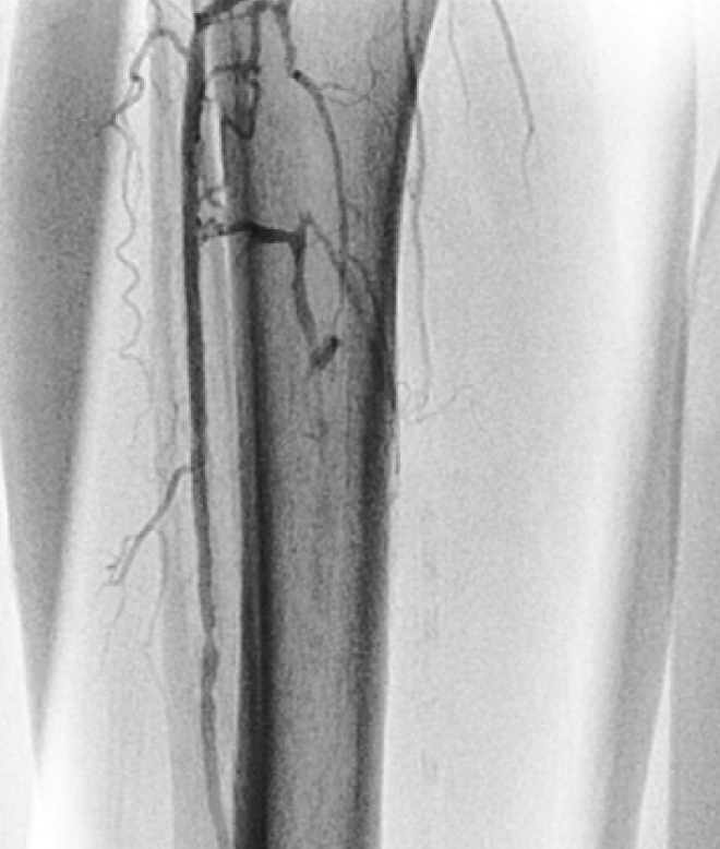 Practice Profile: Longer Equipment Means 50% Growth in Radial-to ...