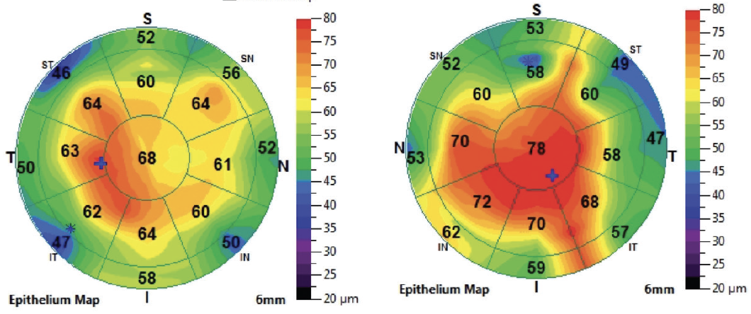 Optimize Your Specialty Lens Fitting Success - Modern Optometry